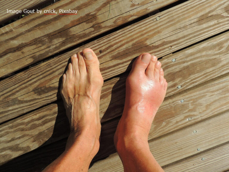 Difference Between Edema and Lymphedema — And Why It Matters ...
